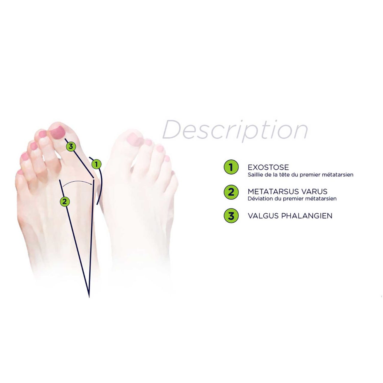 Hallux Valgus Nice | Chirurgie pied Nice | Docteur Becquet | Définition